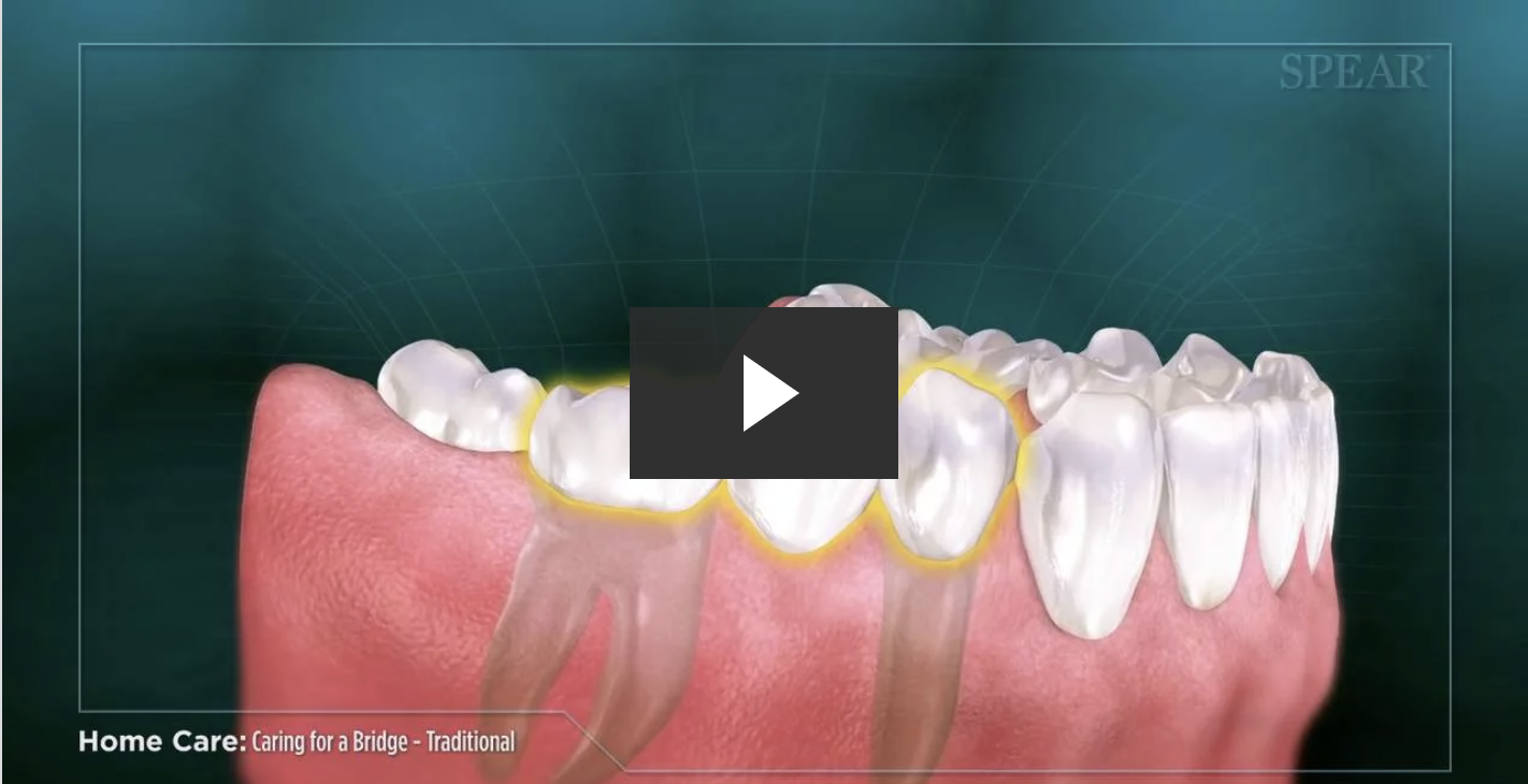 Caring For A Tradtional Tooth Bridge At Home