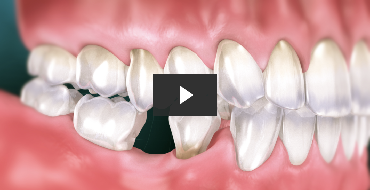 Missing Posterior Tooth Replacement With Implant - 89A Dental Care