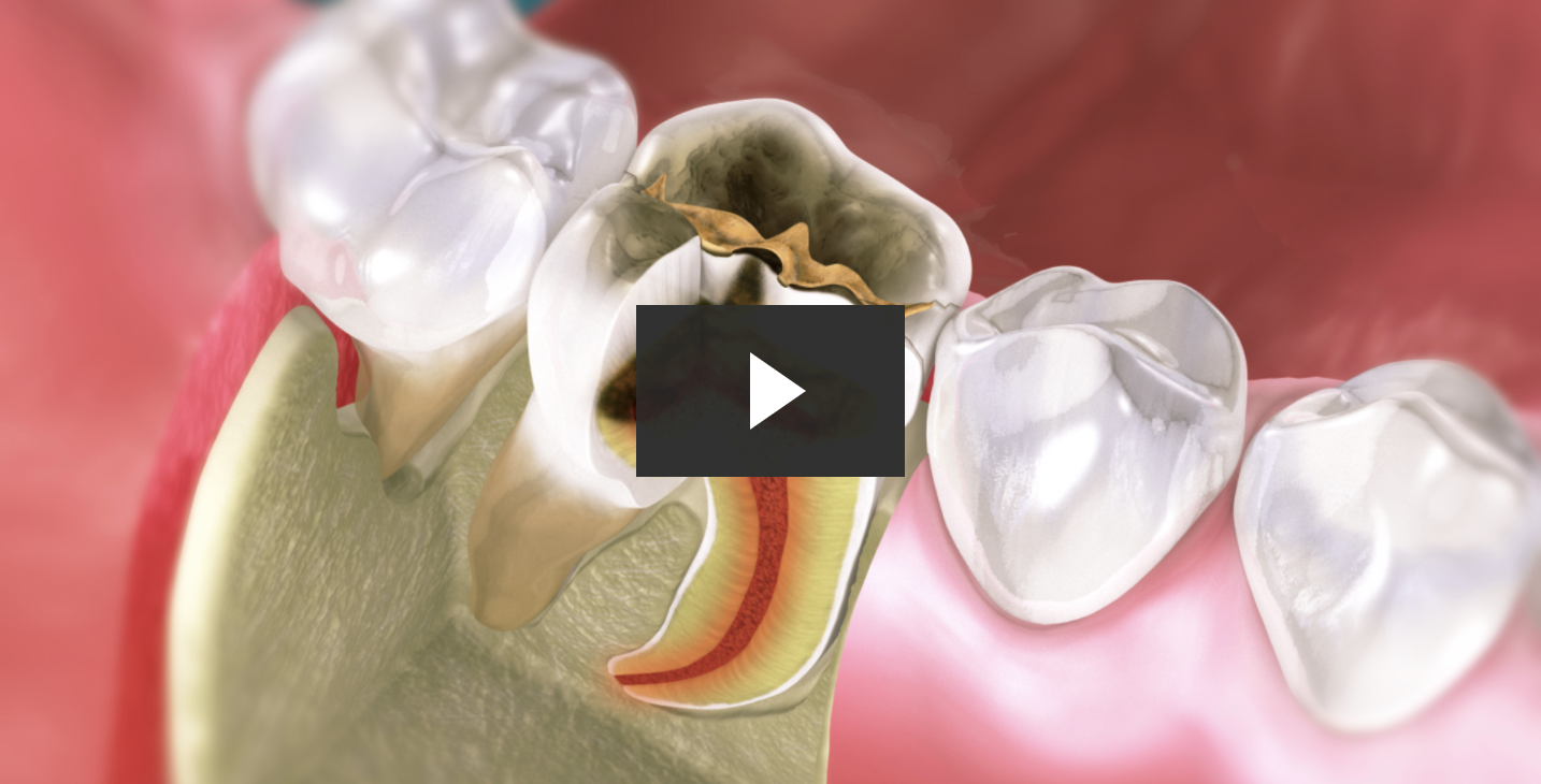 Repairing Posterior Tooth Decay with a Crown (CAD/CAM) - 89A Dental Care
