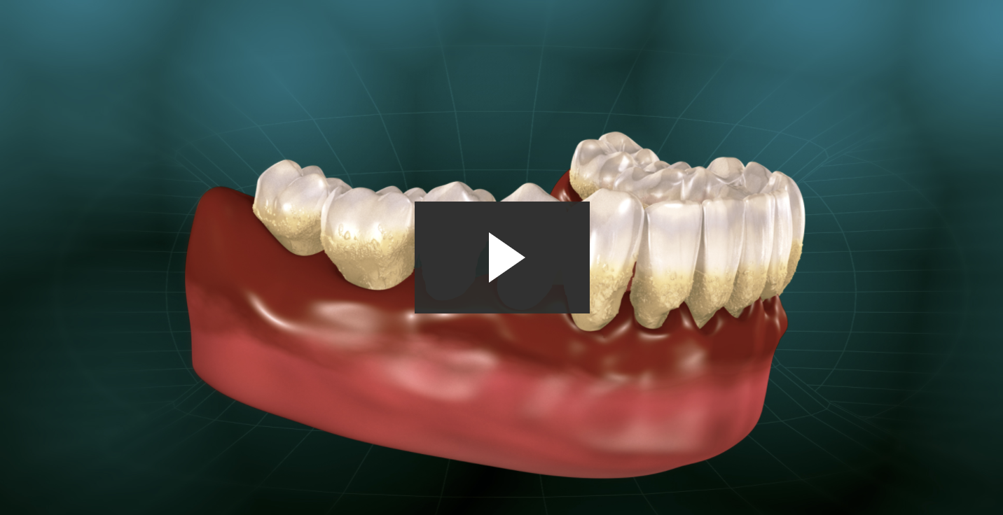 Treating Periodontitis with Connective Tissue Graft - 89A Dental Care